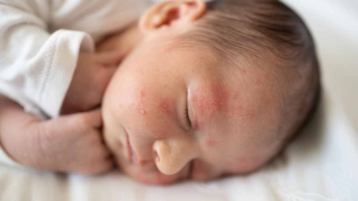 Acné neonatal: por qué aparece y cómo tratarlo