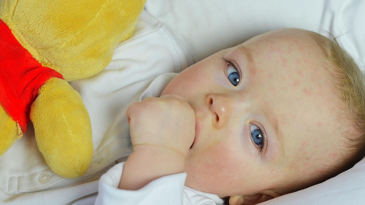 Exanatemas virales: qué son y cuál es su tratamiento