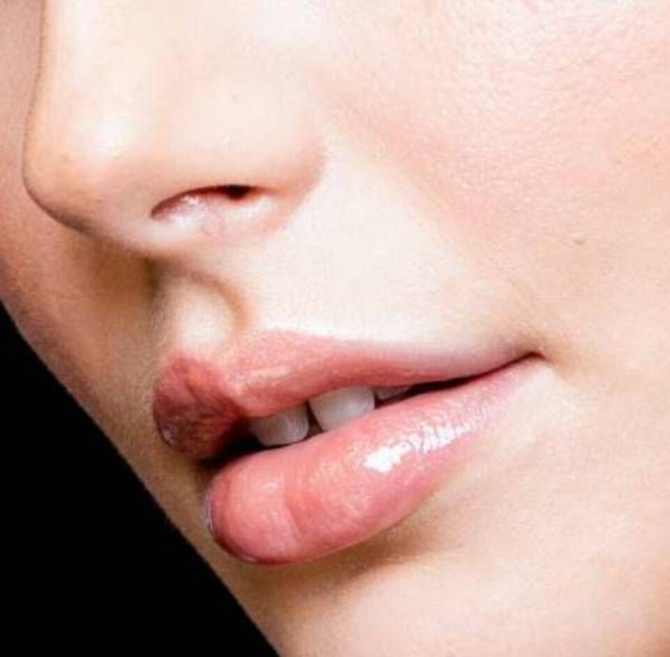 Qué es la hidratación de labios con ácido hialurónico, el tratamiento ...
