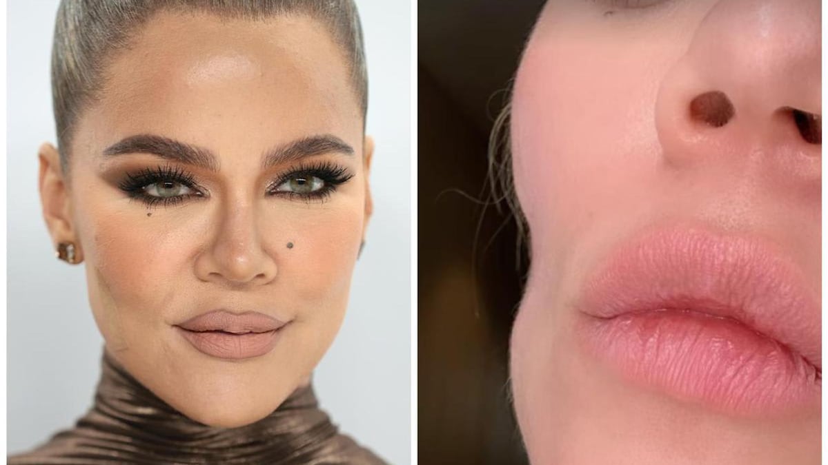 Khloé Kardashian shows her cheek indentation after melanoma