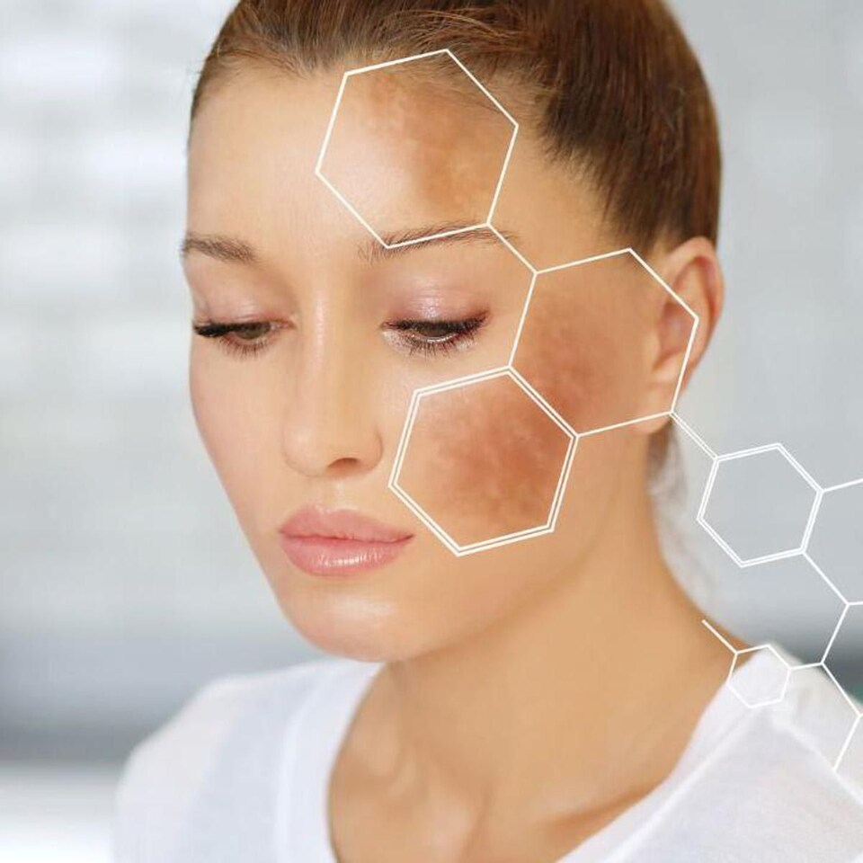 Hyperpigmentation in Latinas: Causes, impacts, and treatments